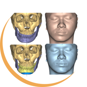Orthognathic (Jaw) Surgery | Oral & Maxillofacial Consultants